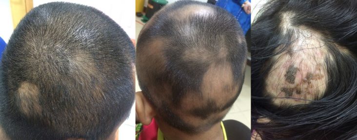 Hair Disorders Hair Loss Excessive Hair Growth My